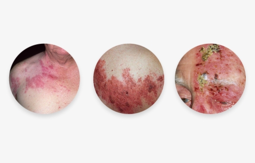 Shingles Rash Png - Shingles On The Head , Free Transparent Clipart ...