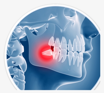 Illustration Of Jaw In Blue With Wisdom Tooth In Red - Wisdom Teeth ...