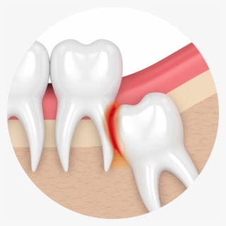 Wisdom Teeth Removal , Free Transparent Clipart - ClipartKey