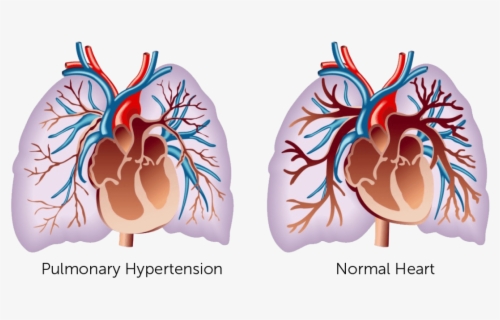 Pulmonary Edema , Free Transparent Clipart - ClipartKey