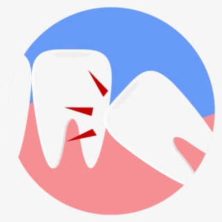 Illustration Of Jaw In Blue With Wisdom Tooth In Red - Wisdom Teeth ...