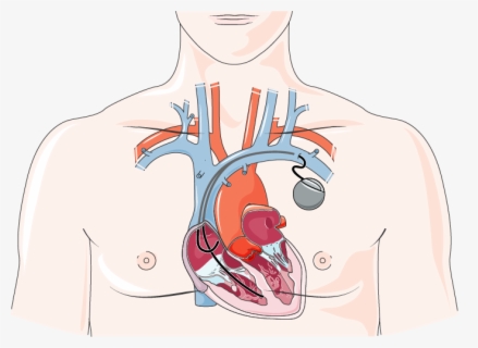 Pacemaker Clip Art , Png Download - Pacemaker Clip Art , Free ...