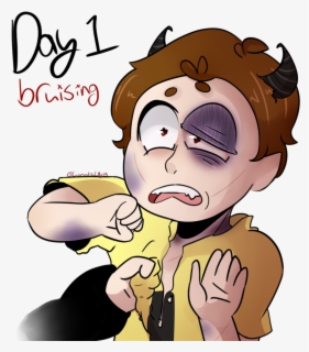 Bruise Transparent Bruises Png , Transparent Cartoons - Bruise Png ...