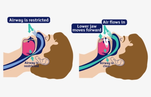 Cartoon Obstructive Sleep Apnea , Free Transparent Clipart - ClipartKey