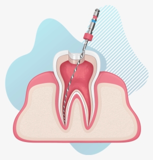 Root Canal Graphic - ทำความ สะอาด คลอง รากฟัน , Free Transparent ...