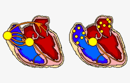 Af With Bundle Branch Block Animation , Free Transparent Clipart ...