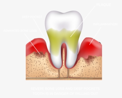 Advanced Periodontitis Illustration - Periodontal Disease Causes , Free ...
