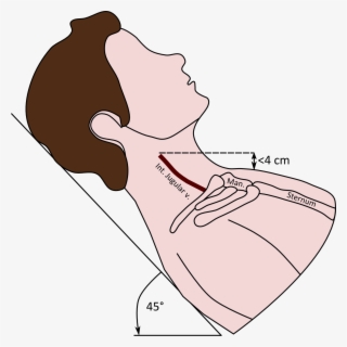 Jugular Venous Pressure Jvp - Sternal Angle Jugular Venous Pressure ...