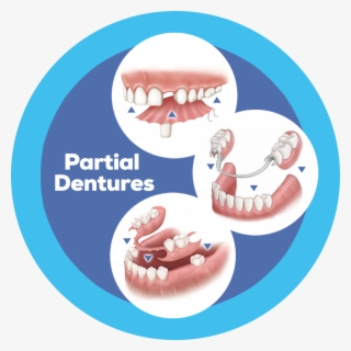 Illustration Of Jaw In Blue With Wisdom Tooth In Red - Wisdom Teeth ...